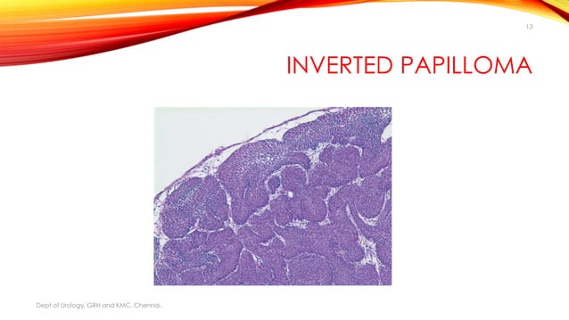 Benign Urinary Bladder Tumors | PDF