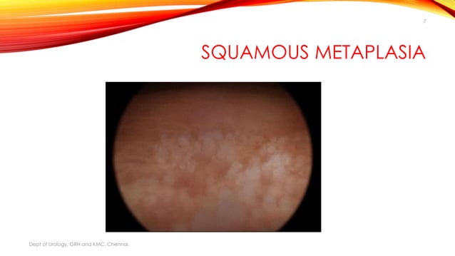 Benign Urinary Bladder Tumors | PDF