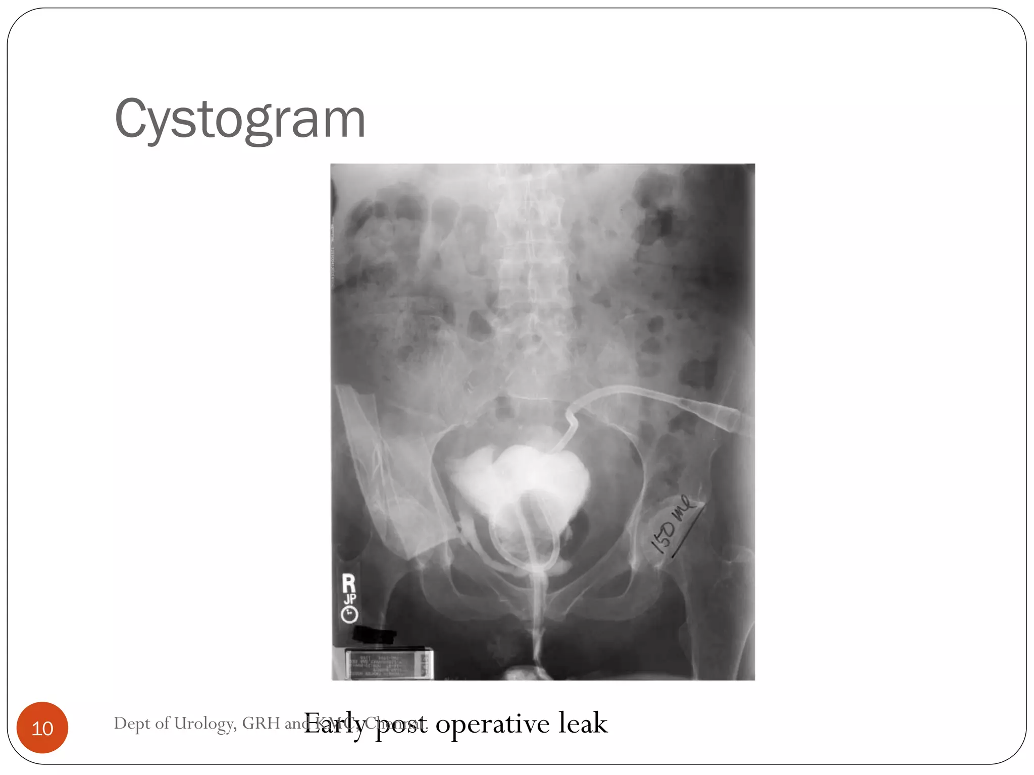 Bladder carcinoma- augmentation cystoplasty complications | PDF