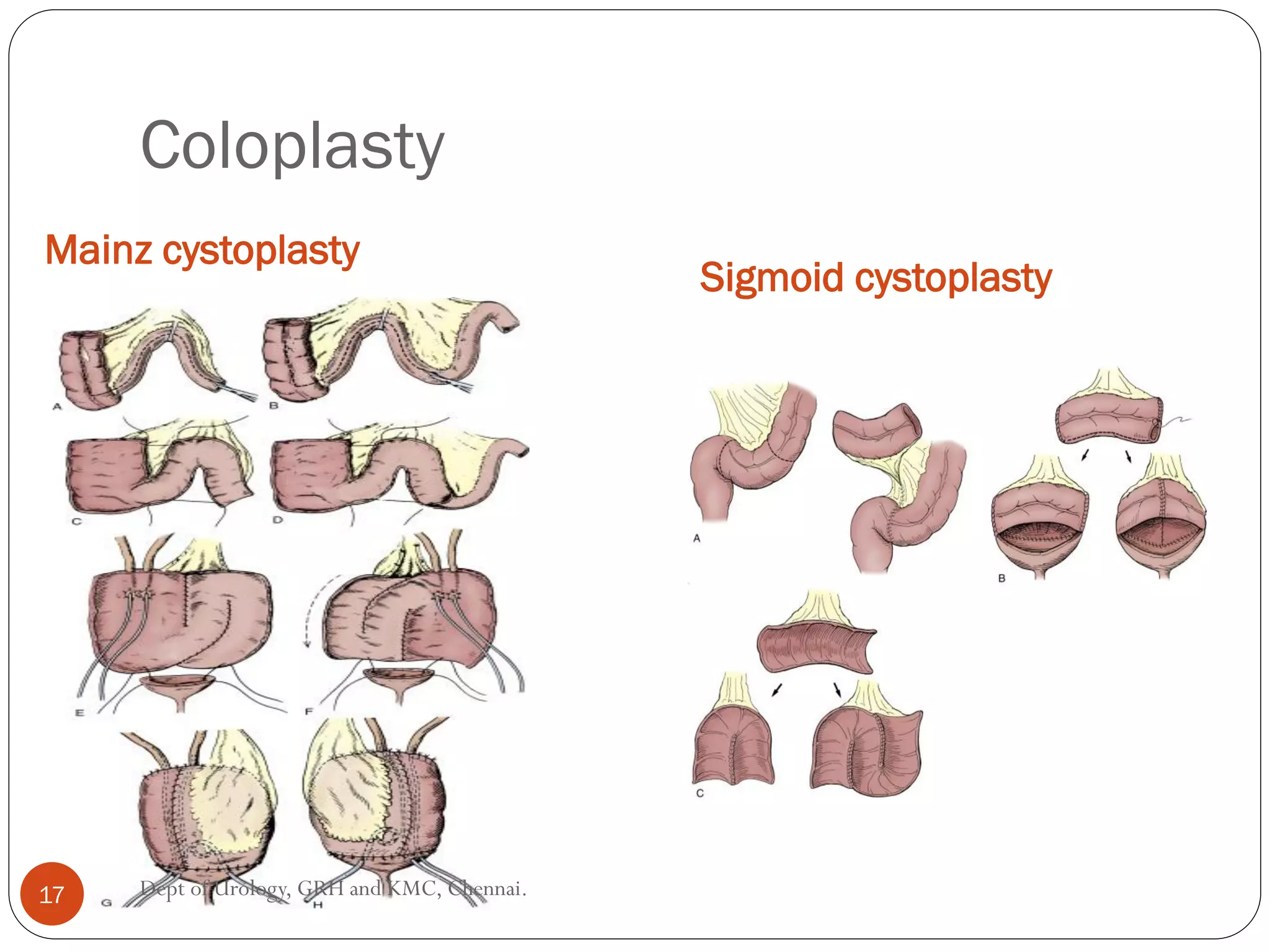 Bladder carcinoma- augmentation cystoplasty complications | PDF