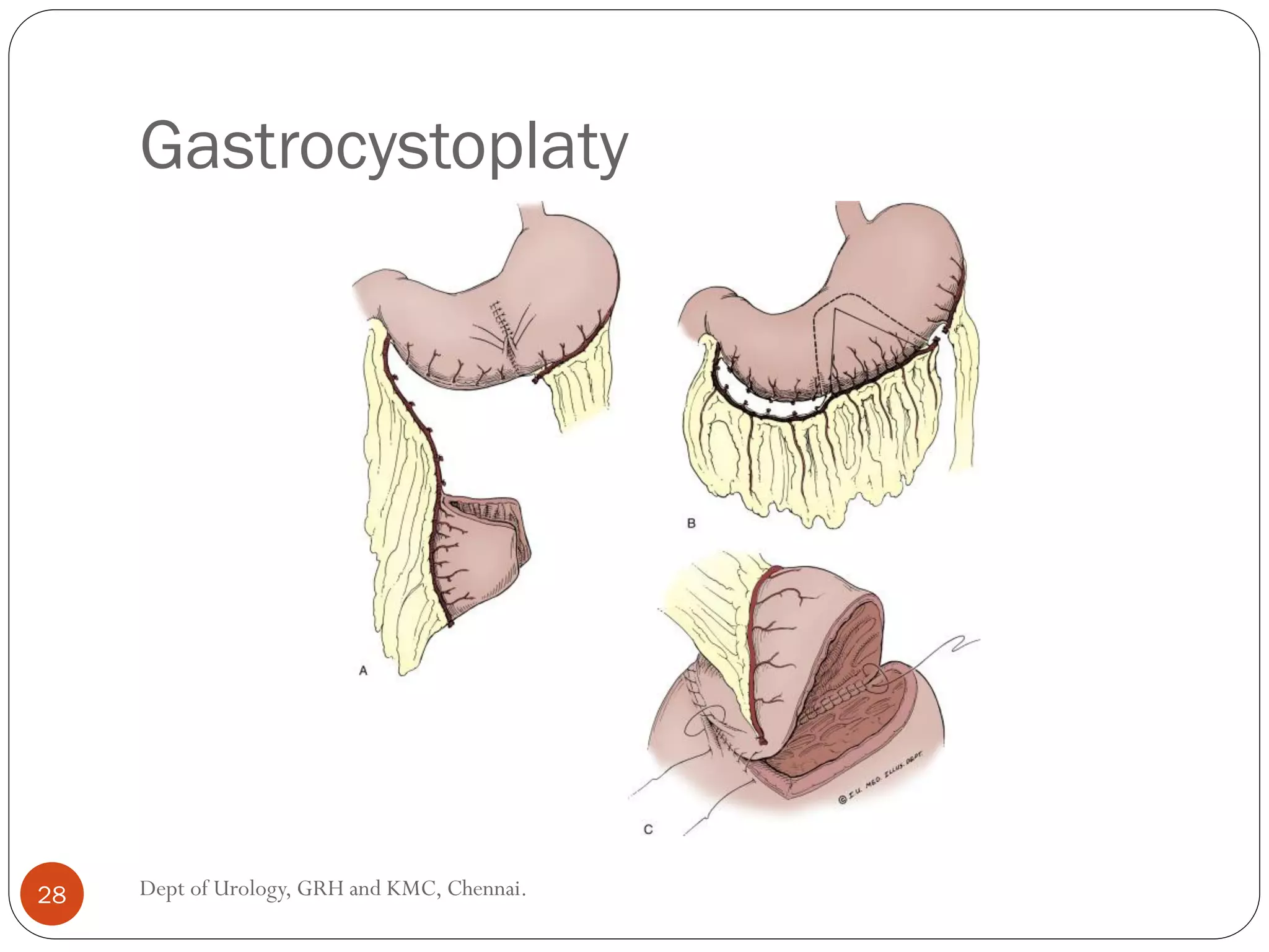Bladder carcinoma- augmentation cystoplasty complications | PDF