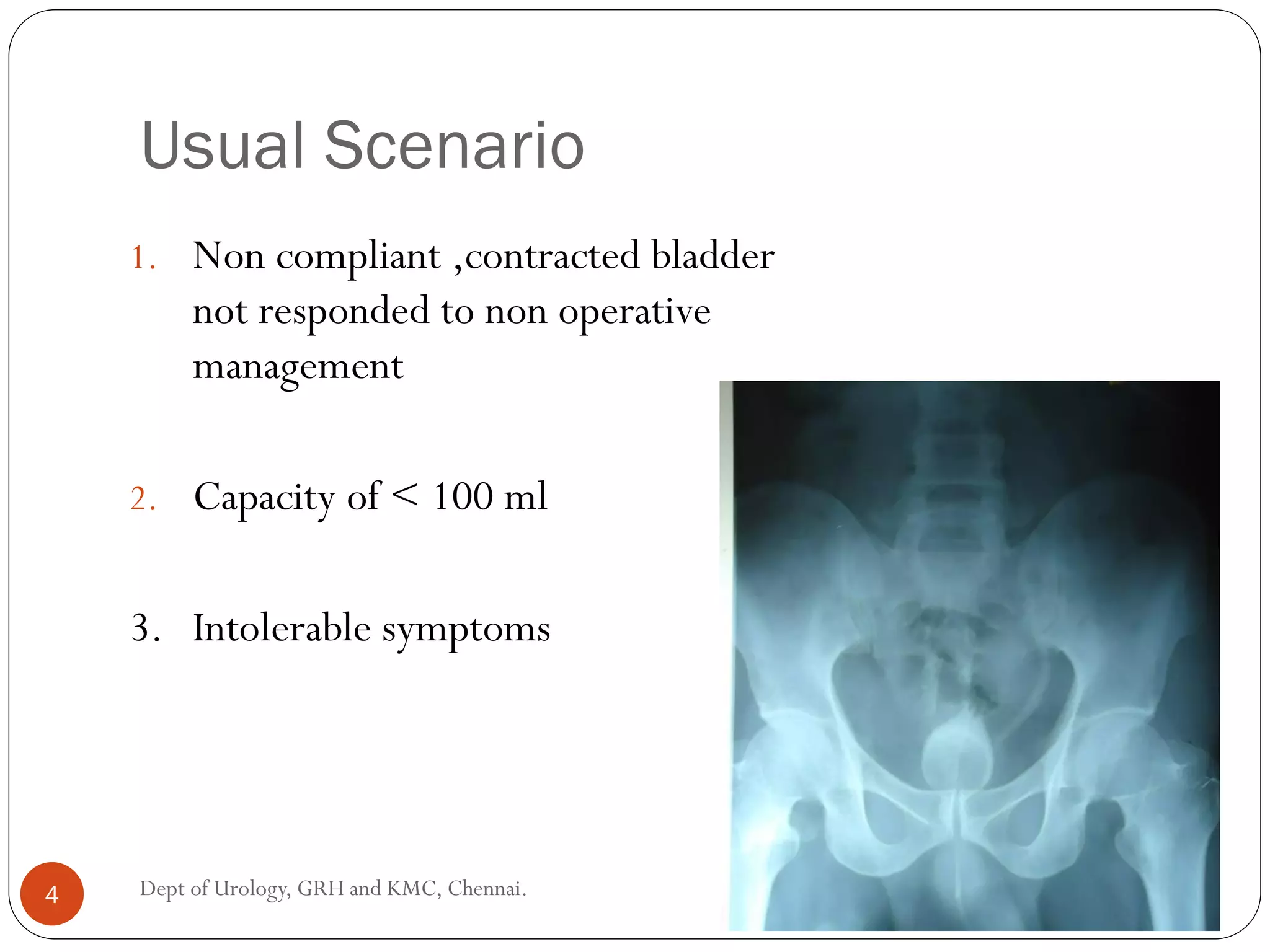 Bladder carcinoma- augmentation cystoplasty complications | PDF