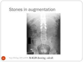 Bladder carcinoma- augmentation cystoplasty complications | PDF