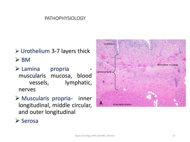 Etiopathogenesis Urinary bladder malignancy | PPT