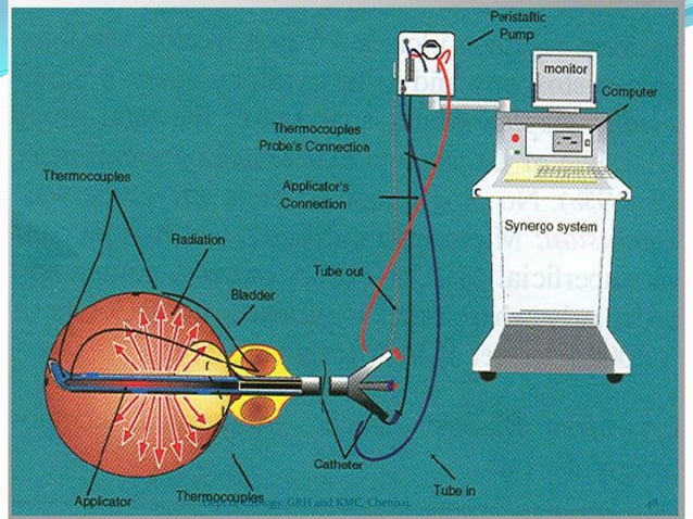 Bladder carcinoma- intravesical therapy | PDF | Cancer | Diseases and ...