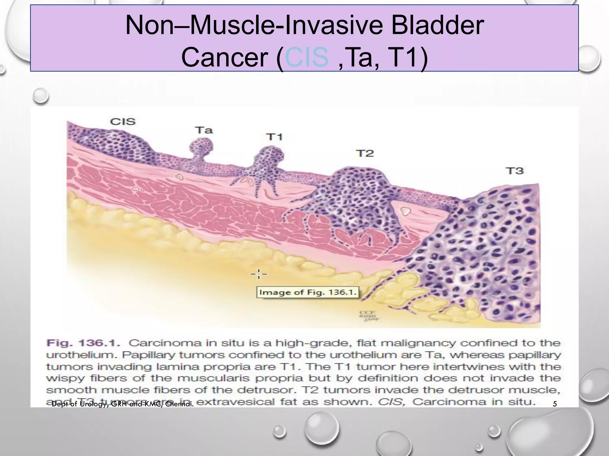 Non muscle invasive bladder carcinoma - management | PDF