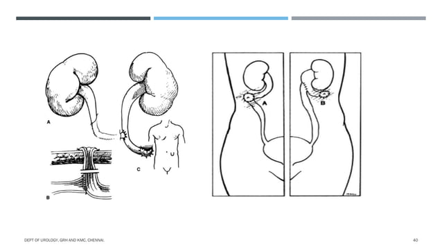 Use of Intestinal segments in urinary diversion | PDF