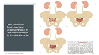 Use of Intestinal segments in urinary diversion | PDF