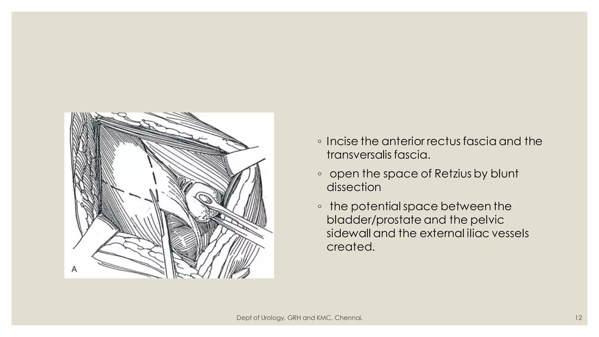 Radical cystectomy | PDF