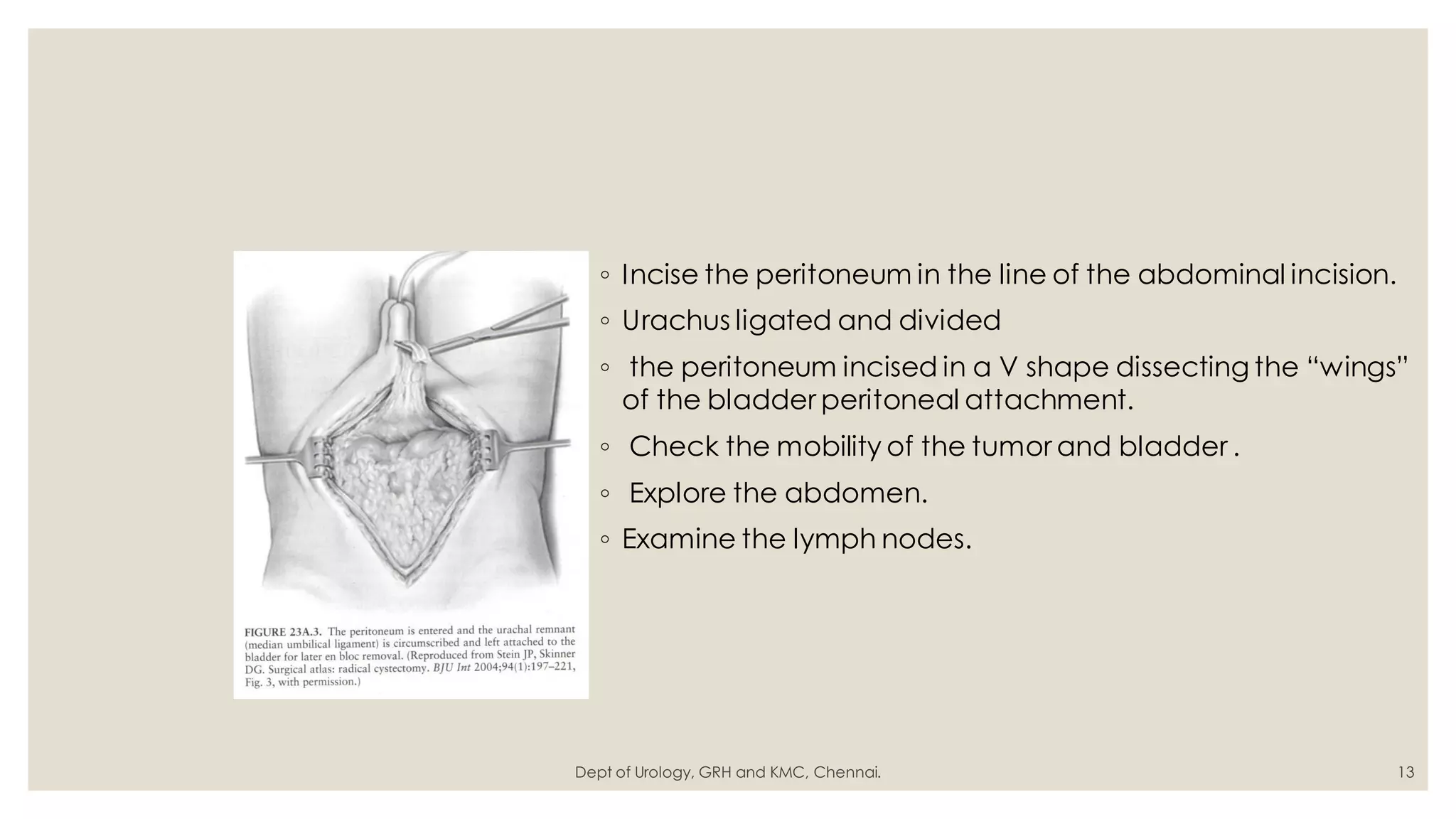 Radical cystectomy | PDF