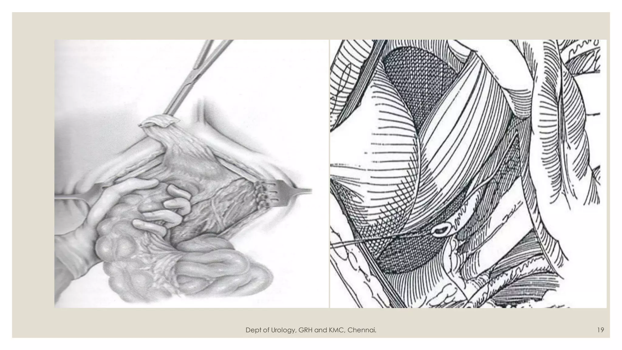 Radical cystectomy | PDF