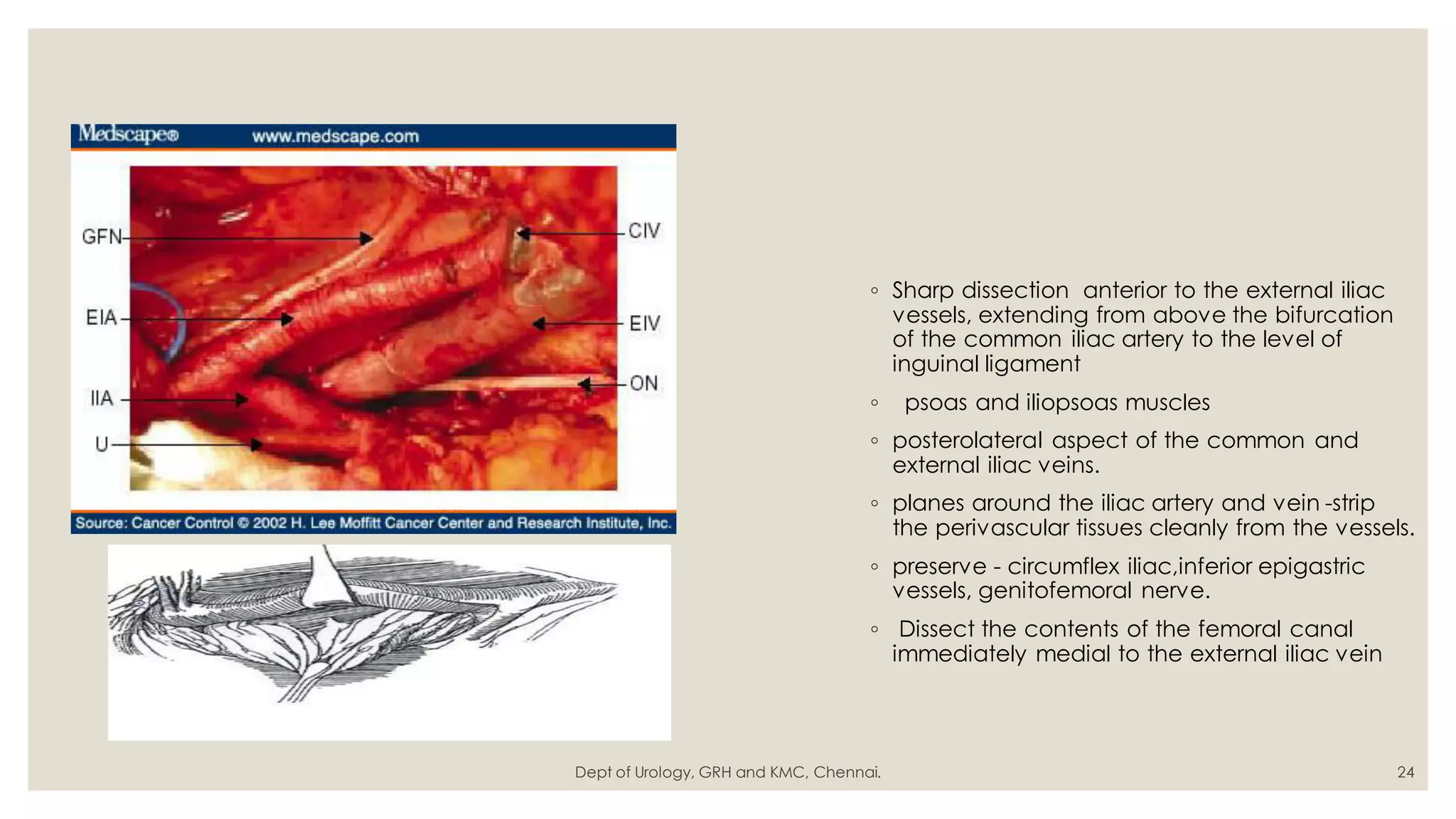 Radical cystectomy | PDF