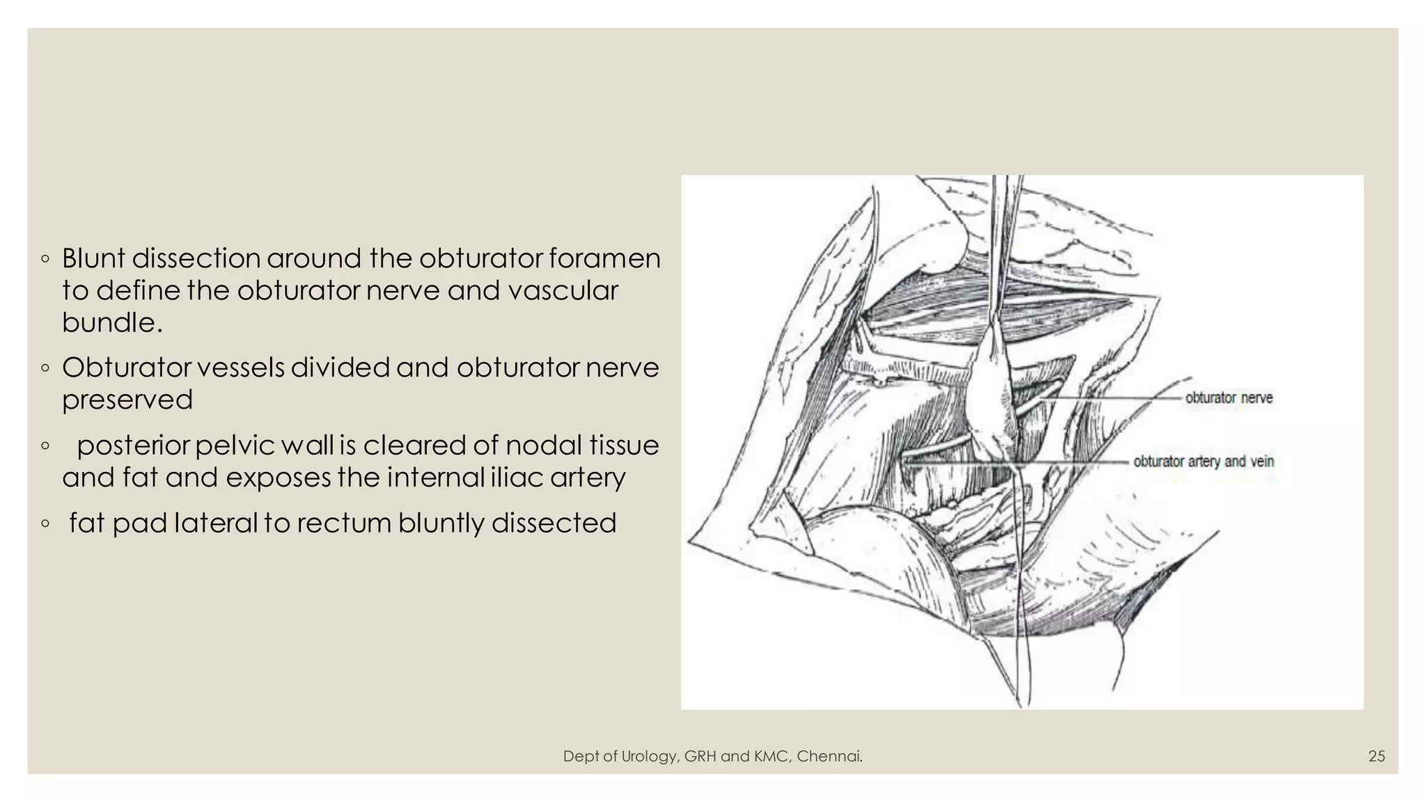Radical cystectomy | PDF