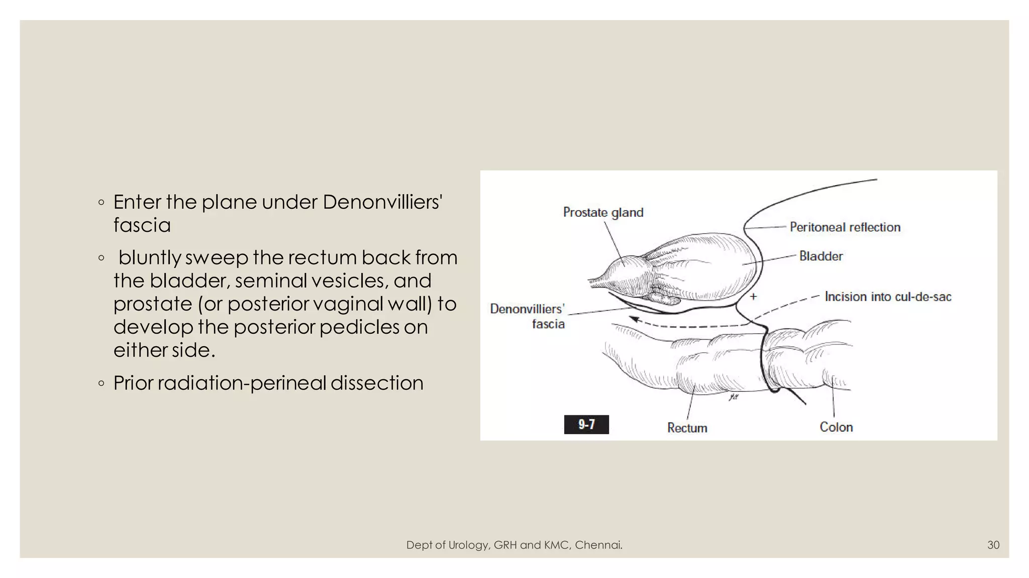 Radical cystectomy | PDF