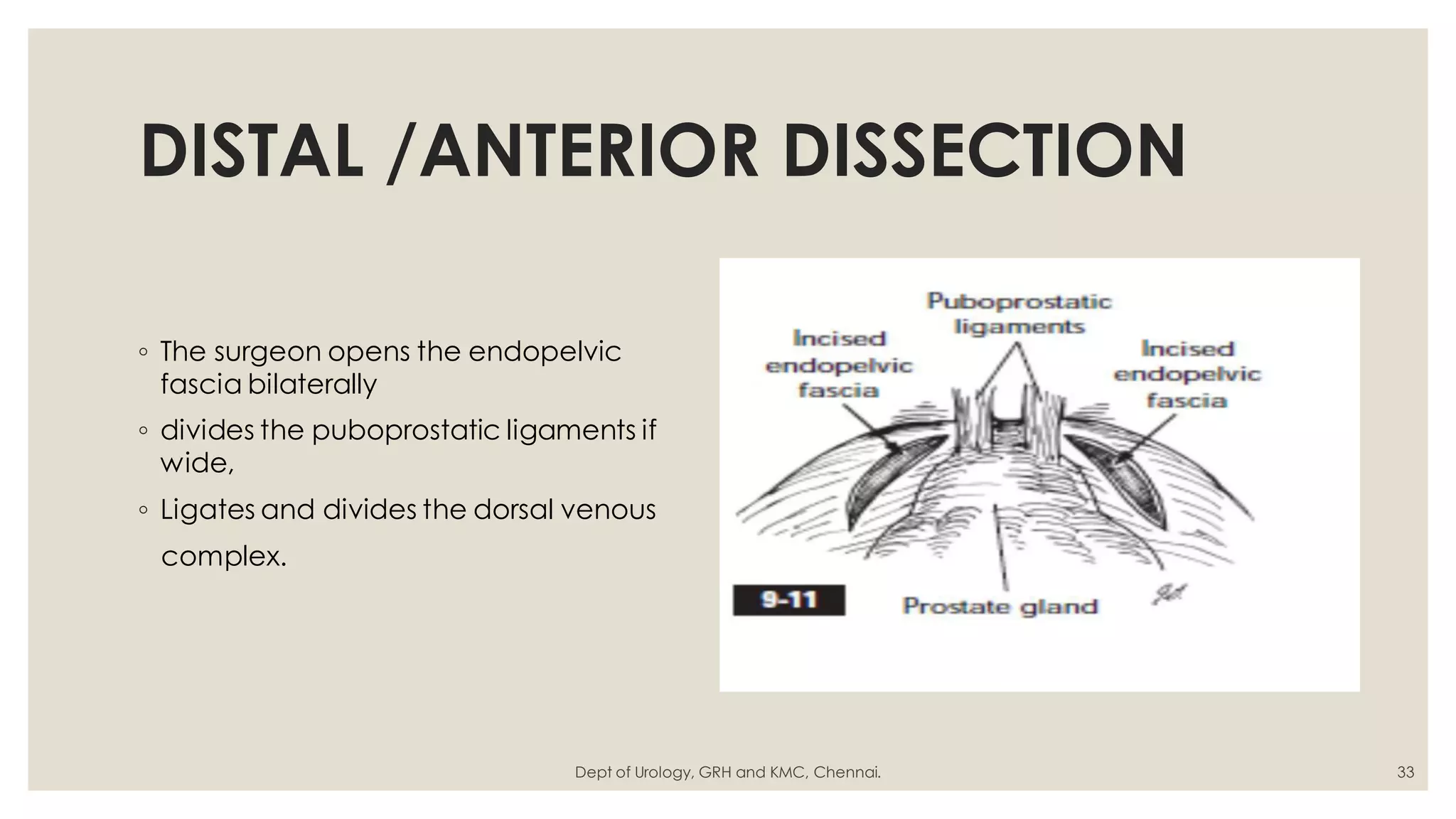 Radical cystectomy | PDF