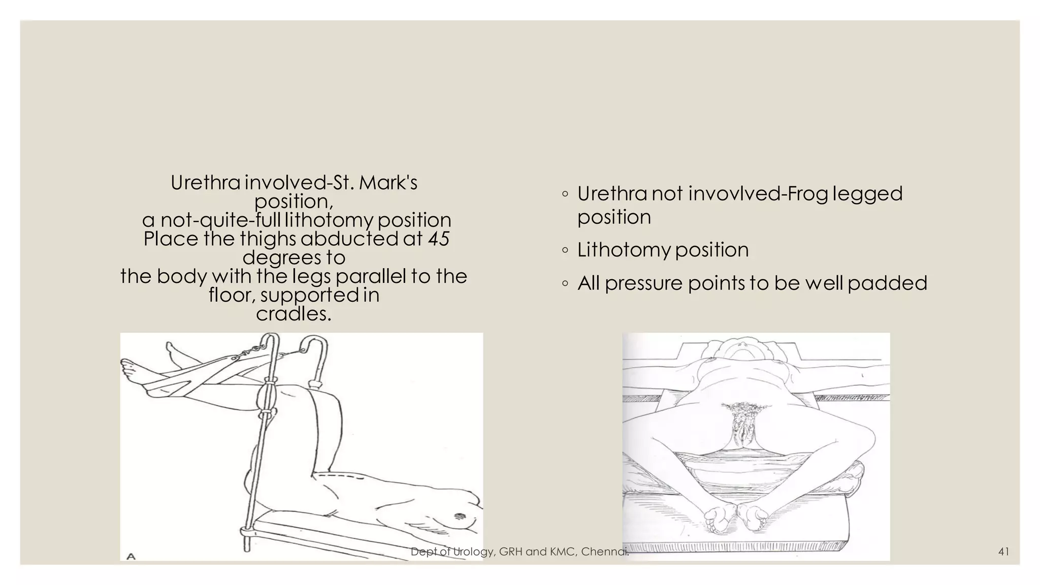 Radical cystectomy | PDF