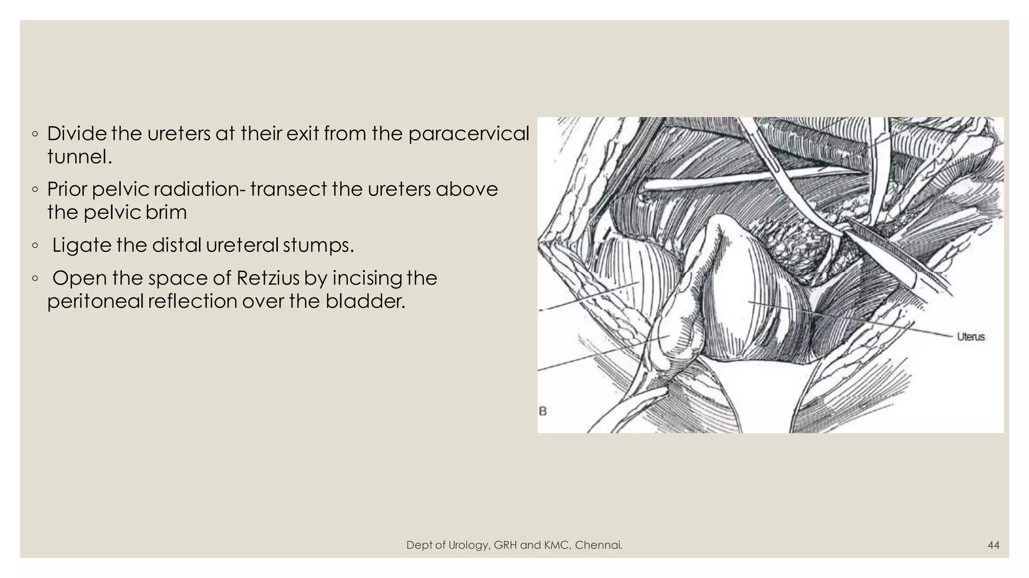 Radical cystectomy | PDF