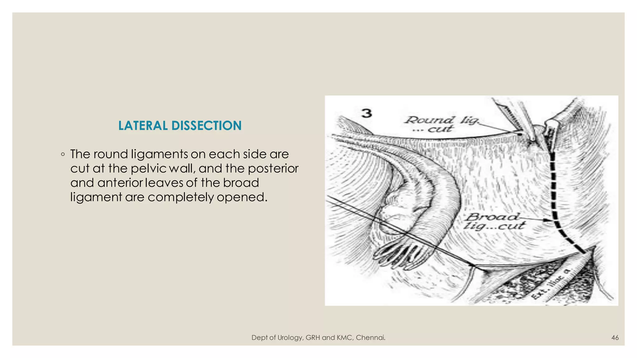 Radical cystectomy | PDF