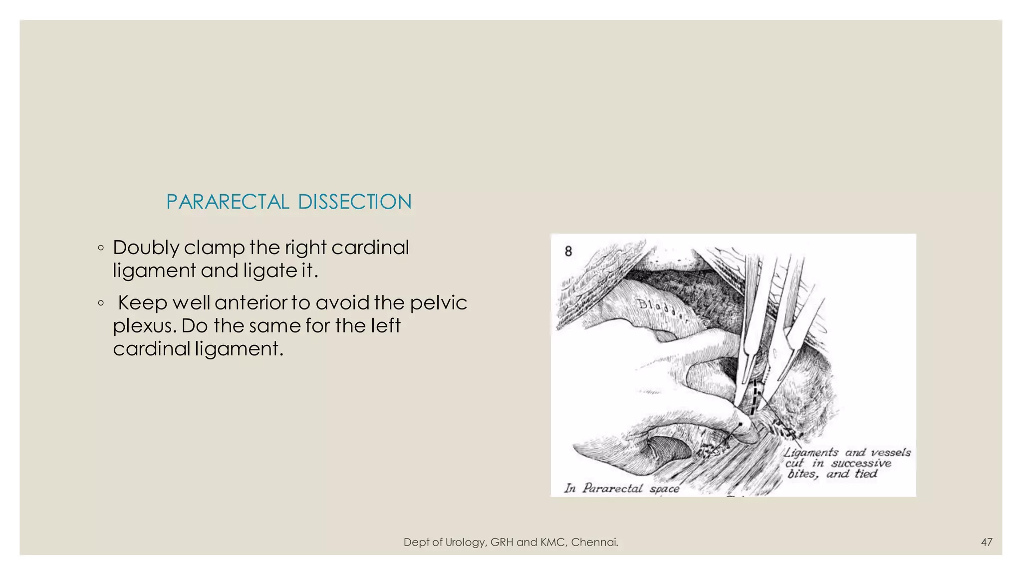 Radical cystectomy | PDF