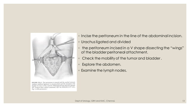 Radical cystectomy | PDF