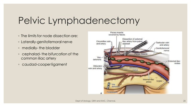 Radical cystectomy | PDF