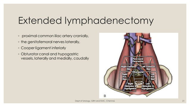 Radical cystectomy | PDF