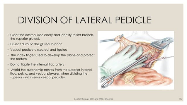 Radical cystectomy | PDF