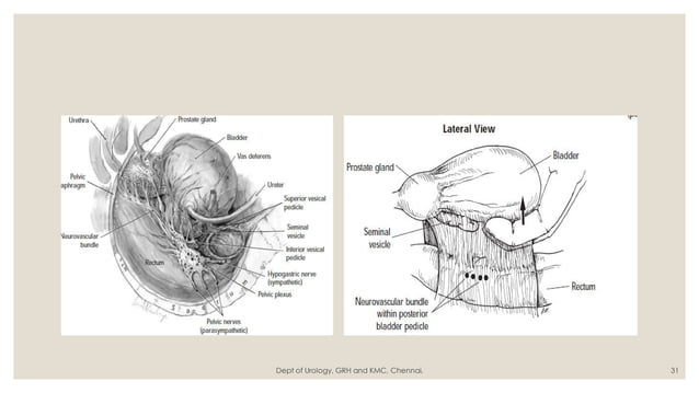 Radical cystectomy | PDF