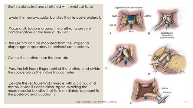 Radical cystectomy | PDF