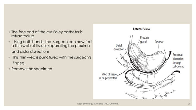 Radical cystectomy | PDF