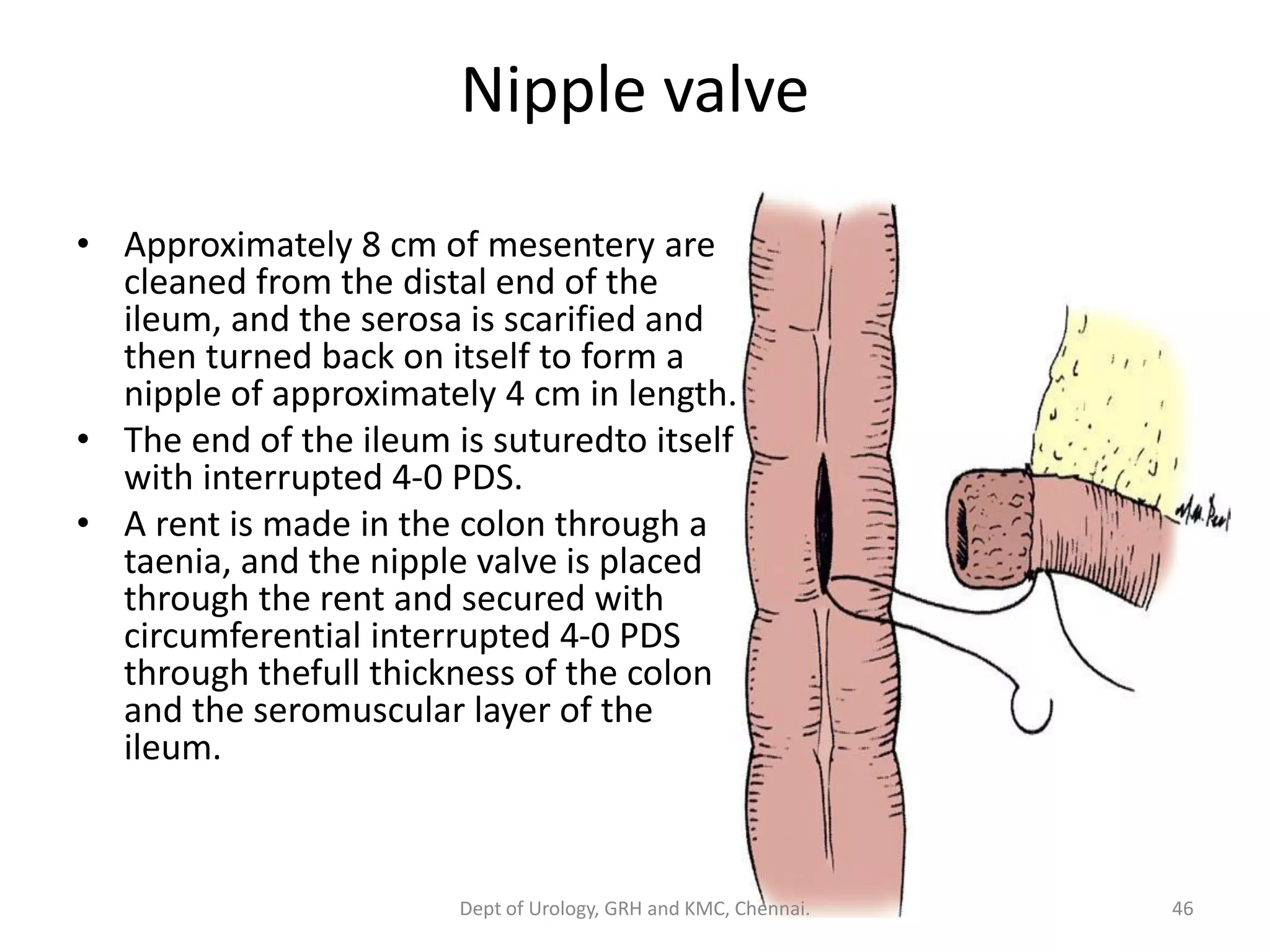 Bladder carcinoma- surgery- substitution | PPT