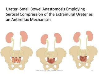 Bladder carcinoma- surgery- substitution | PDF