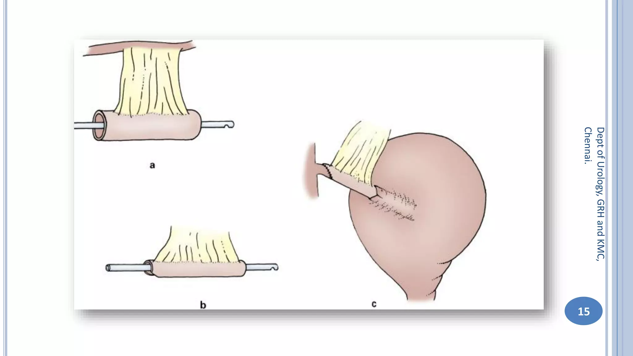 Bladder carcinoma- surgery- urinary diversion | PDF
