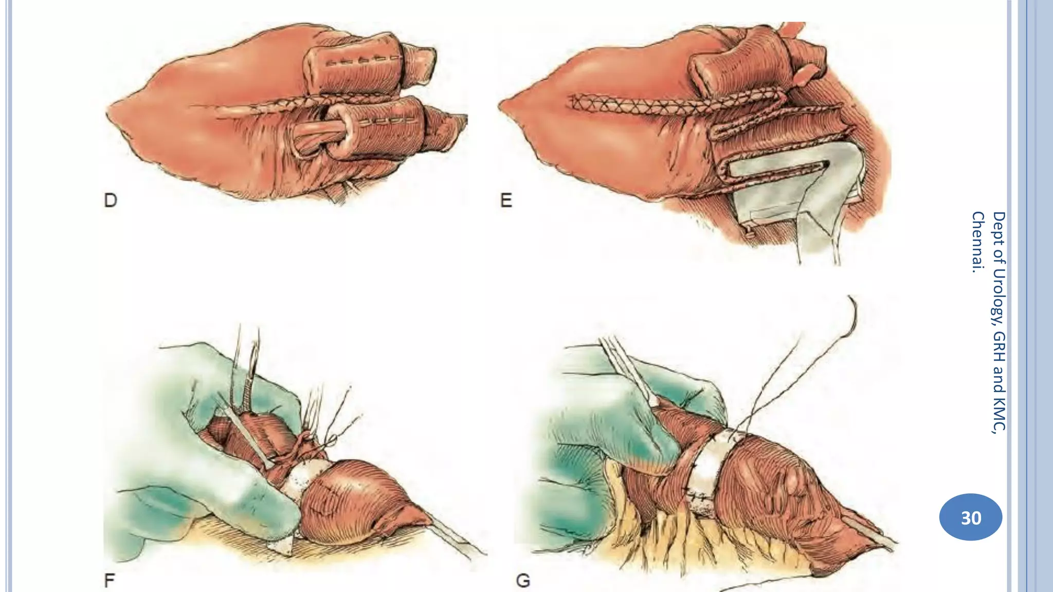 Bladder carcinoma- surgery- urinary diversion | PDF