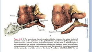 Bladder carcinoma- surgery- urinary diversion | PDF