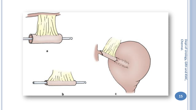Bladder carcinoma- surgery- urinary diversion | PDF