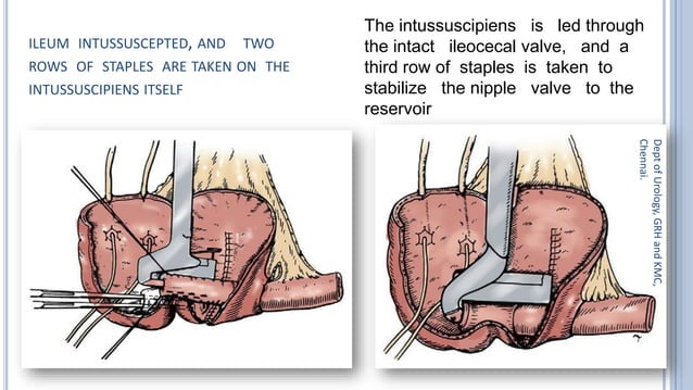 Bladder carcinoma- surgery- urinary diversion | PDF
