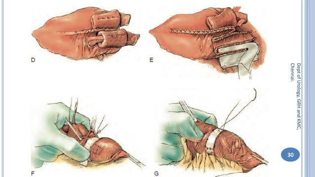 Bladder carcinoma- surgery- urinary diversion | PDF