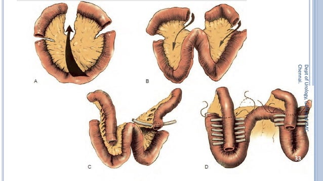 Bladder carcinoma- surgery- urinary diversion | PDF