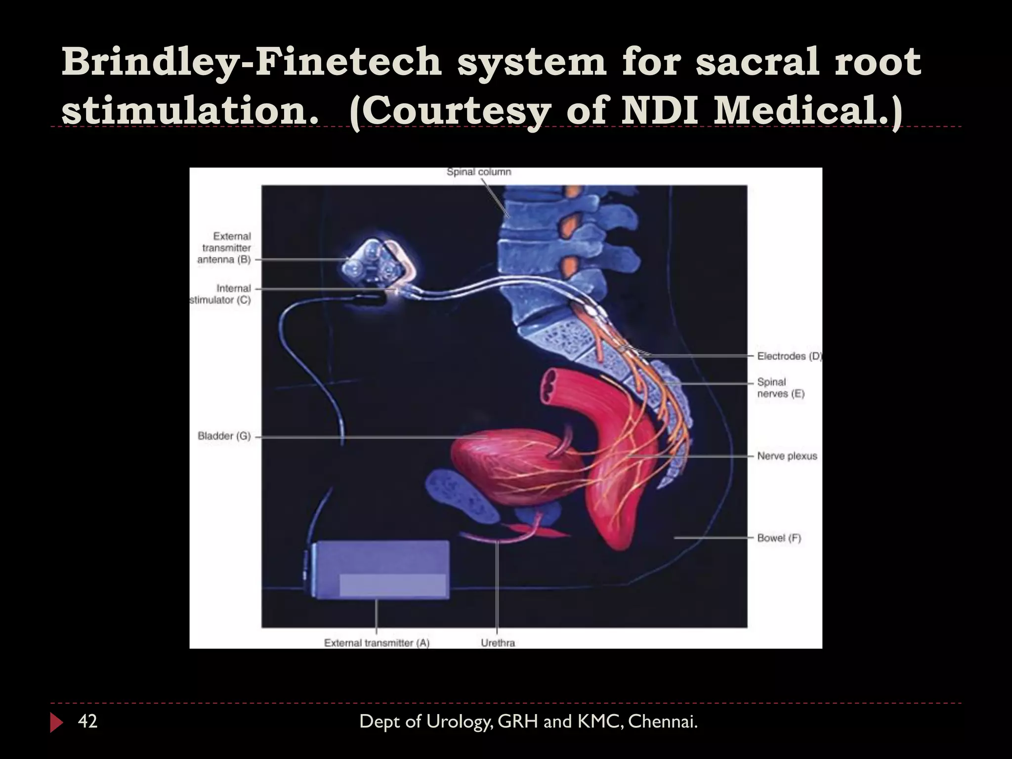 Bladder neurogenic- management- surgical | PDF | Physical Therapy ...