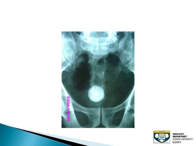 Bladder and urethral calculi | PPTX | Digestive Disorders | Diseases ...