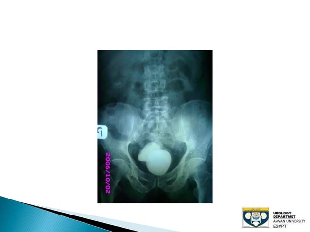 Bladder and urethral calculi | PPTX | Digestive Disorders | Diseases ...