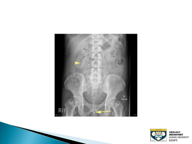 Bladder and urethral calculi | PPTX | Digestive Disorders | Diseases ...