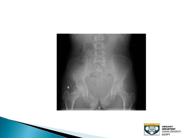 Bladder and urethral calculi | PPTX | Digestive Disorders | Diseases ...
