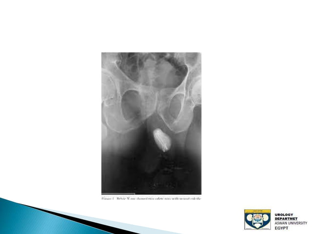 Bladder and urethral calculi | PPTX | Digestive Disorders | Diseases ...