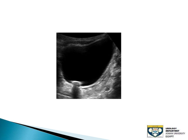 Bladder and urethral calculi | PPTX | Digestive Disorders | Diseases ...