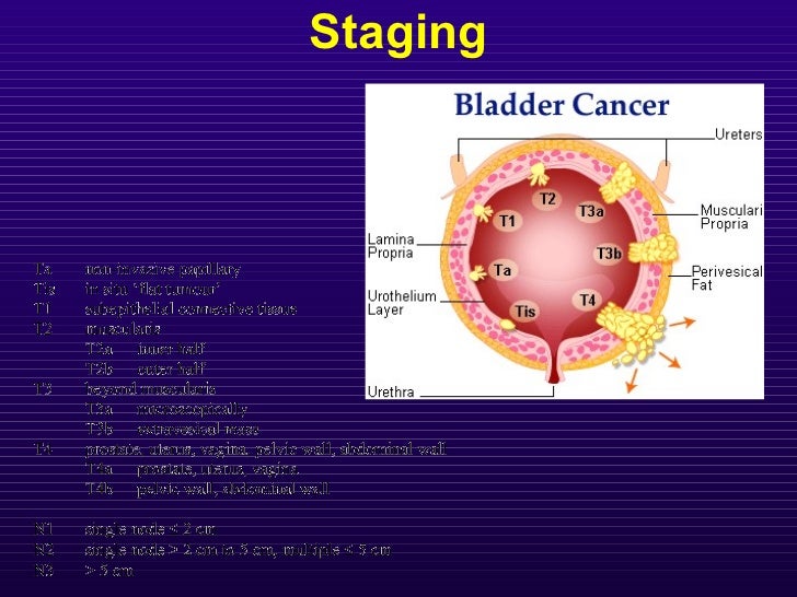 Bladder cancer