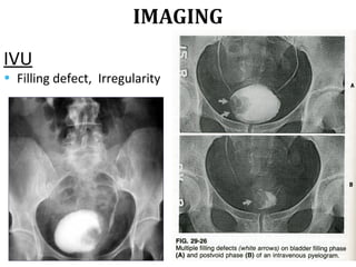 Bladder ca basheer oudah | PPT