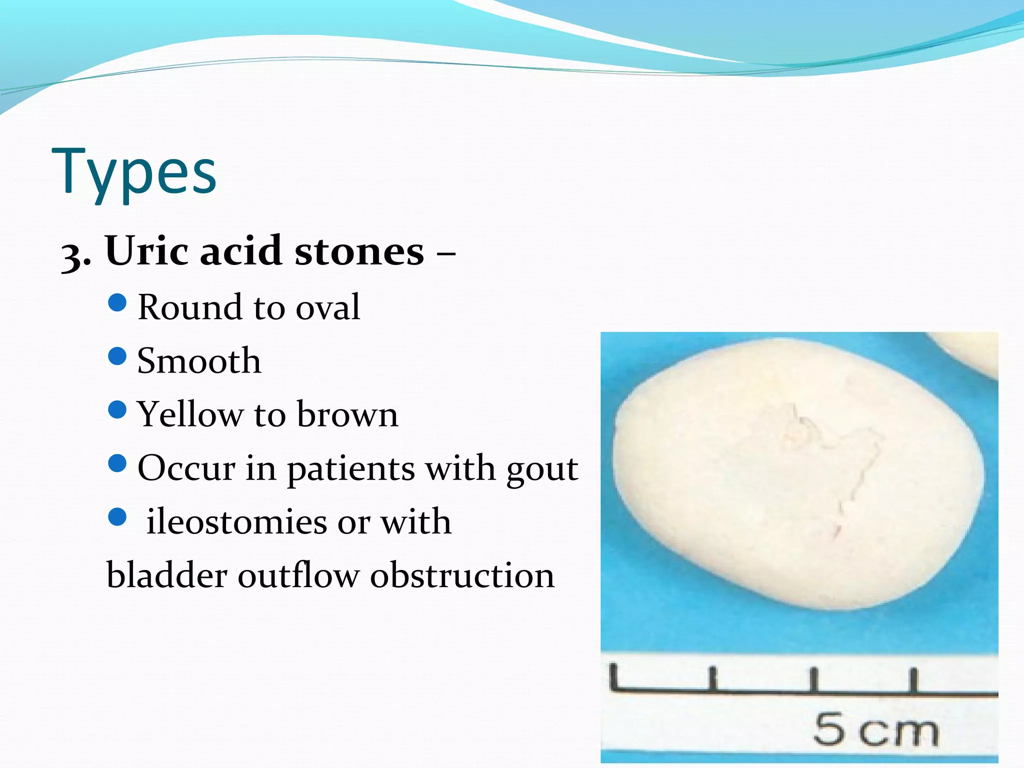 Bladder calculi | PPT