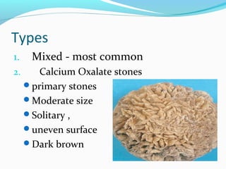 Bladder calculi | PPT